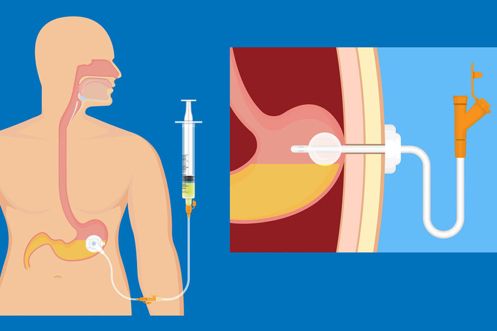 Gastrostomie Dalimentation Gastro Entérologue Lyon