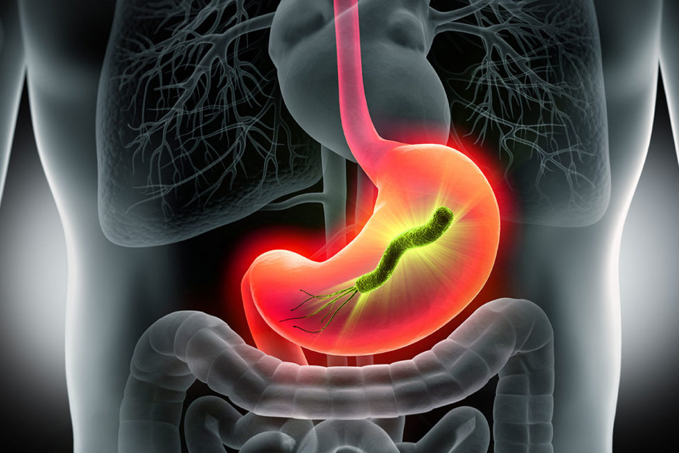 Gastrite et infection par Helicobacter pylori - Gastro-entérologue Lyon